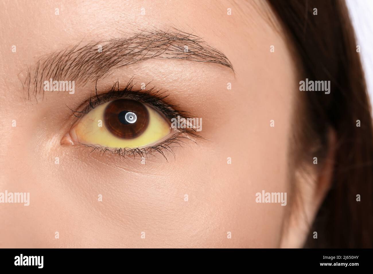Young woman with yellow eyes, closeup. Hepatitis symptom Stock Photo ...