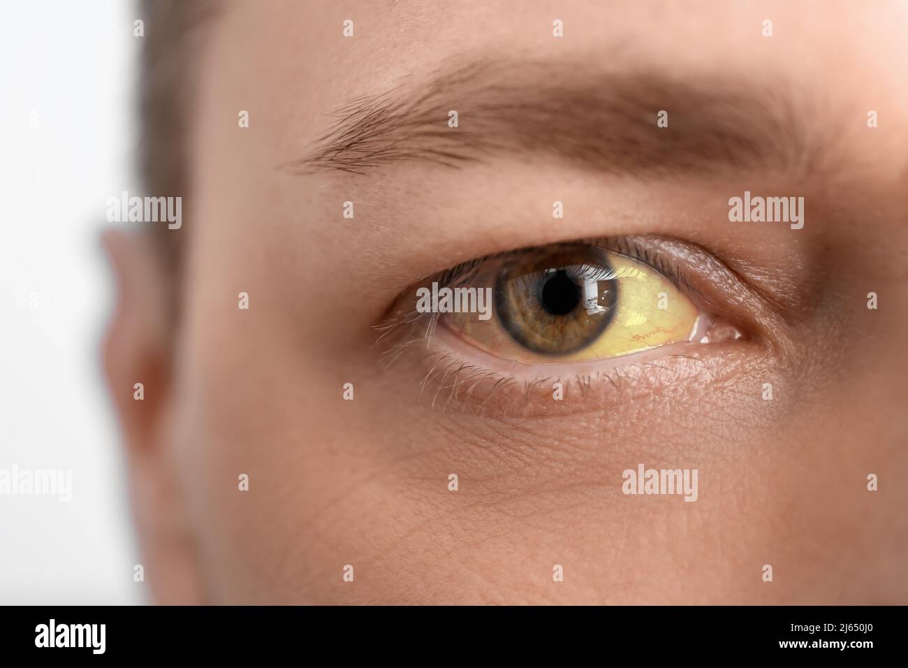 Jaundice Dry Eyes at Isabelle Bloch blog