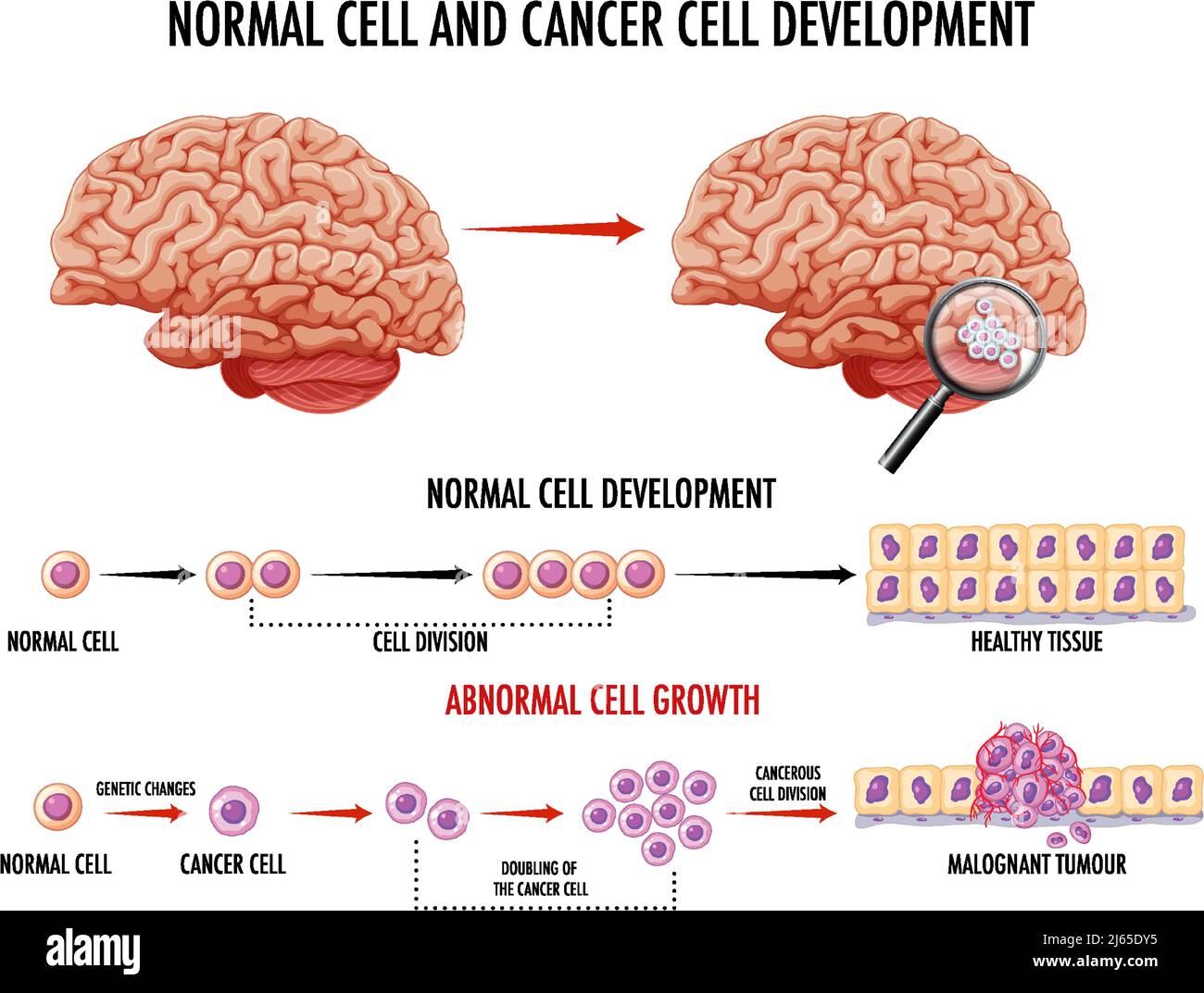 Diagram showing normal and cancer cells in human illustration Stock ...