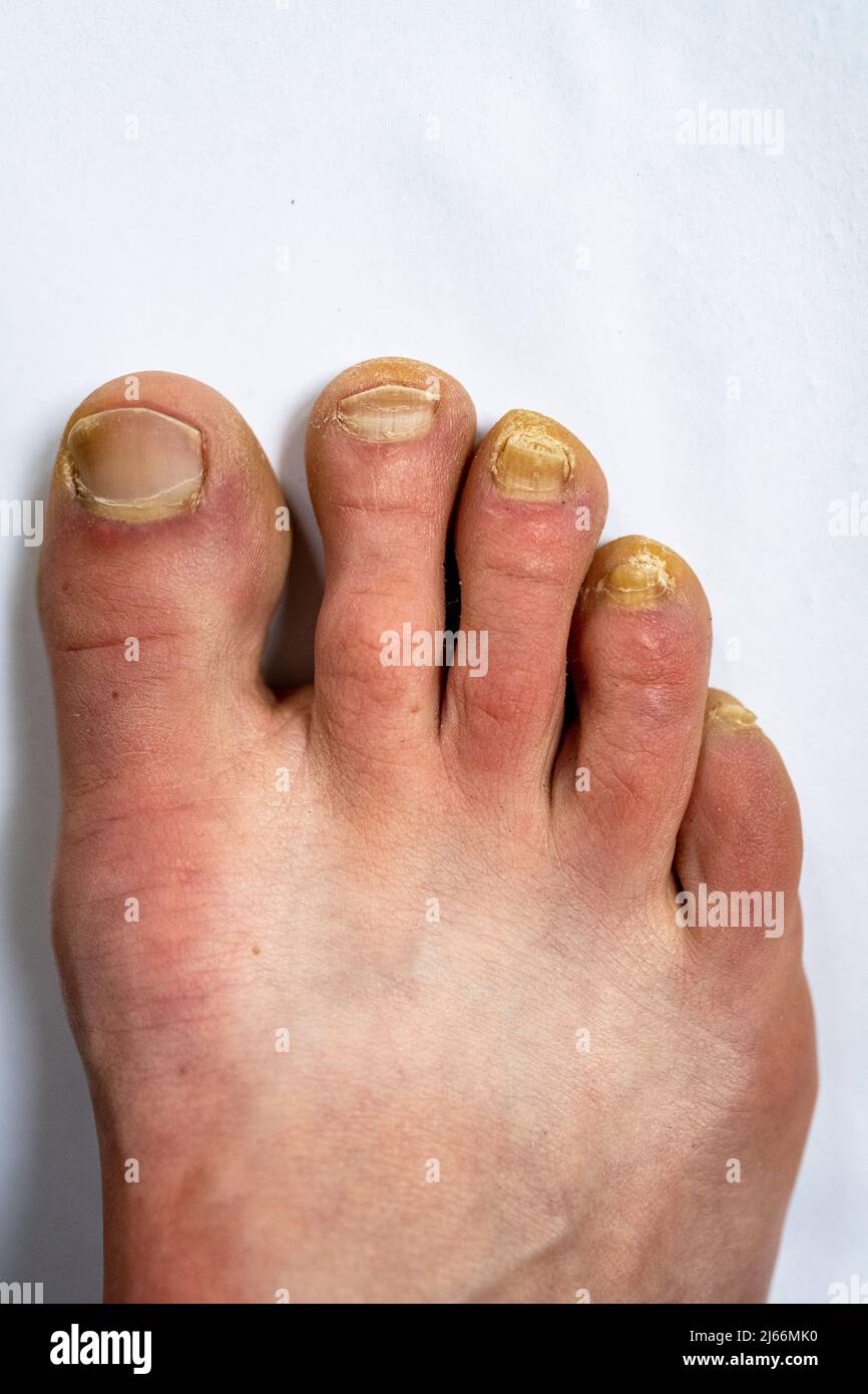 Fungal nail hi-res stock photography and images - Alamy