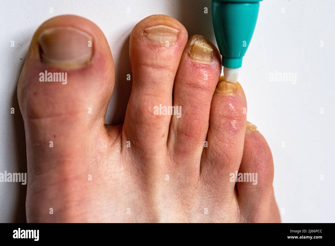 Fungal infection body hi-res stock photography and images - Alamy