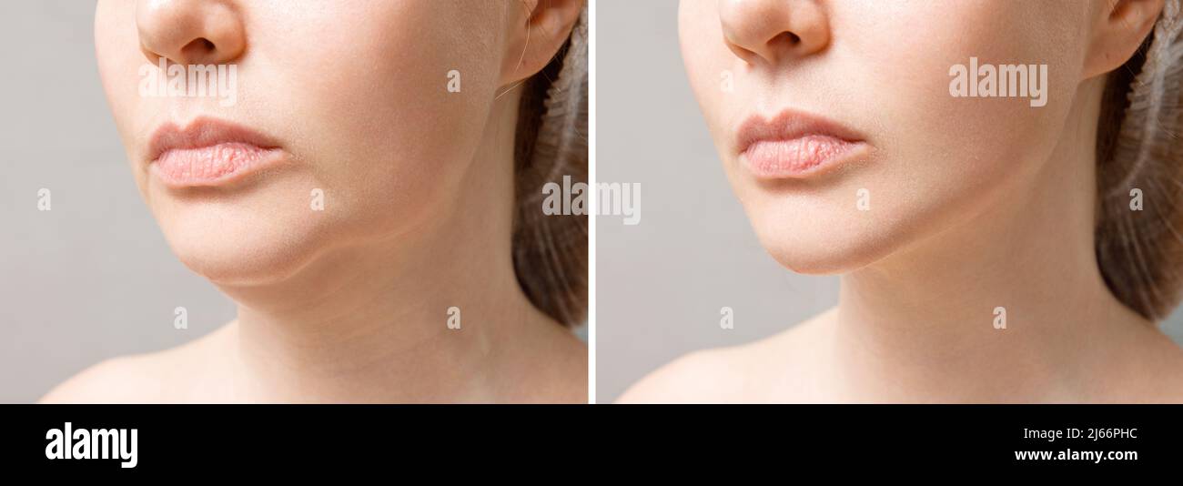 Female double chin before and after correction. Correction of the chin ...