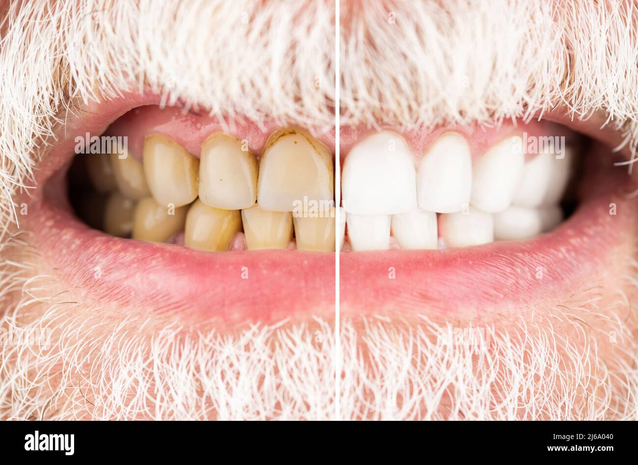 Bad Teeth Whitening