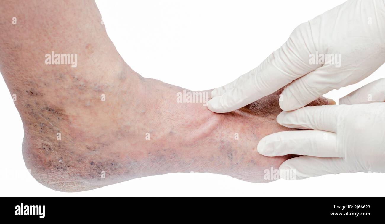 Doctor in white gloves holding man's foot and pointing to varicose ...