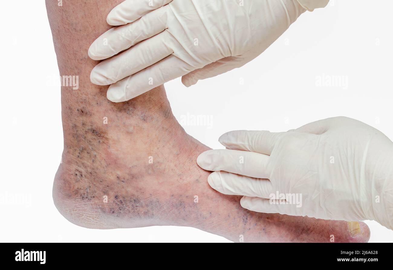 Doctor in white gloves holding man's foot and pointing to varicose ...