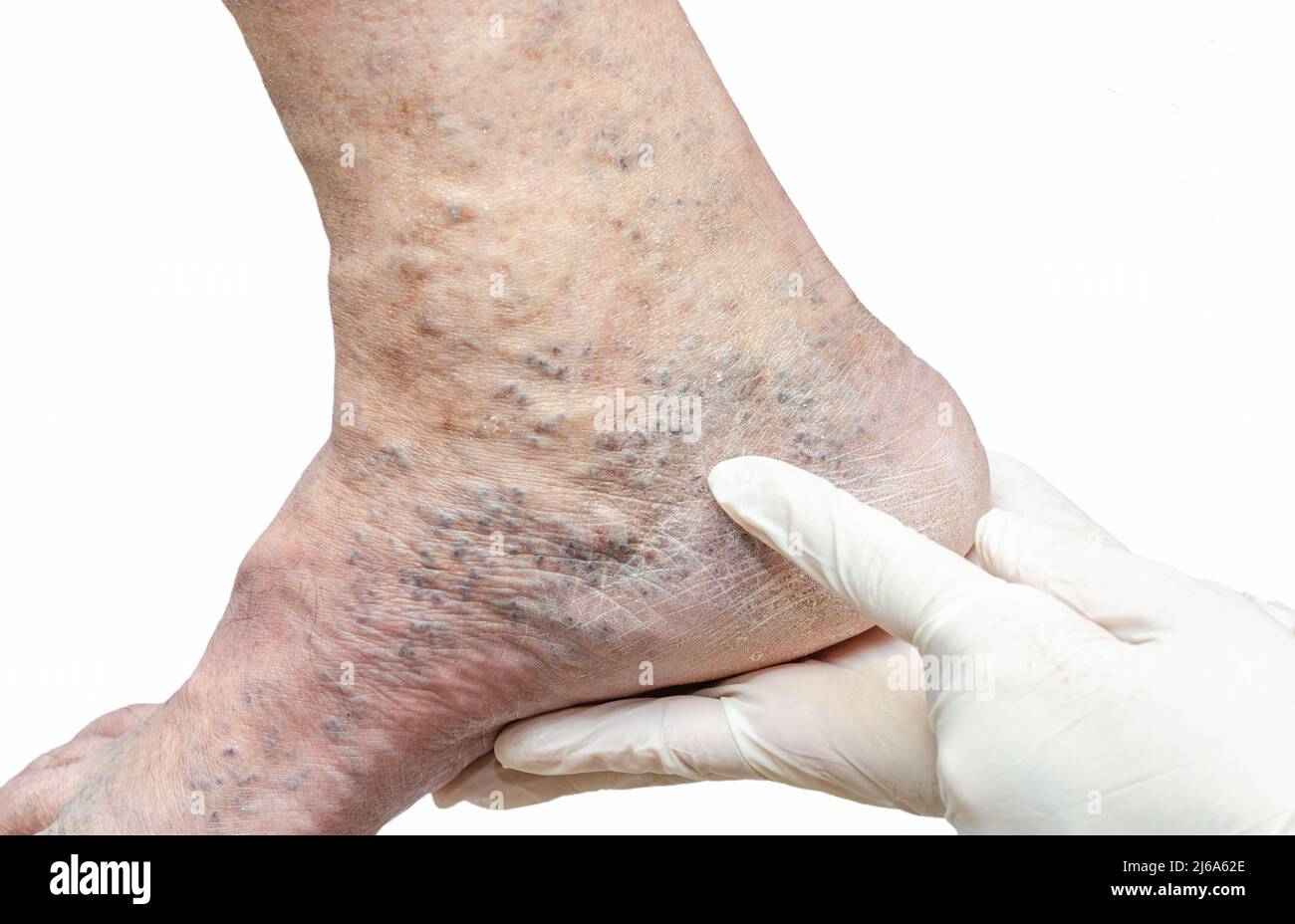Telangiectasias hi-res stock photography and images - Alamy