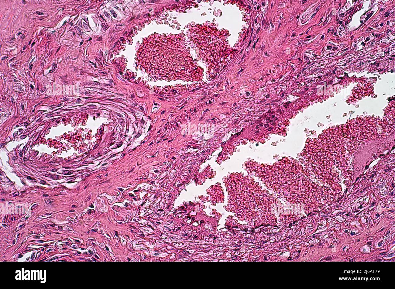 Oesophagitis hi-res stock photography and images - Alamy