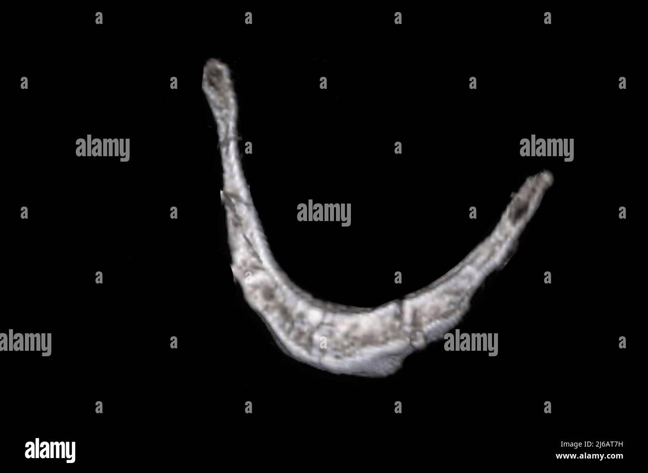 Fractured hyoid bone, 3D CT scan Stock Photo - Alamy Fractured hyoid bone, 3D CT scan Stock Photo - Alamy