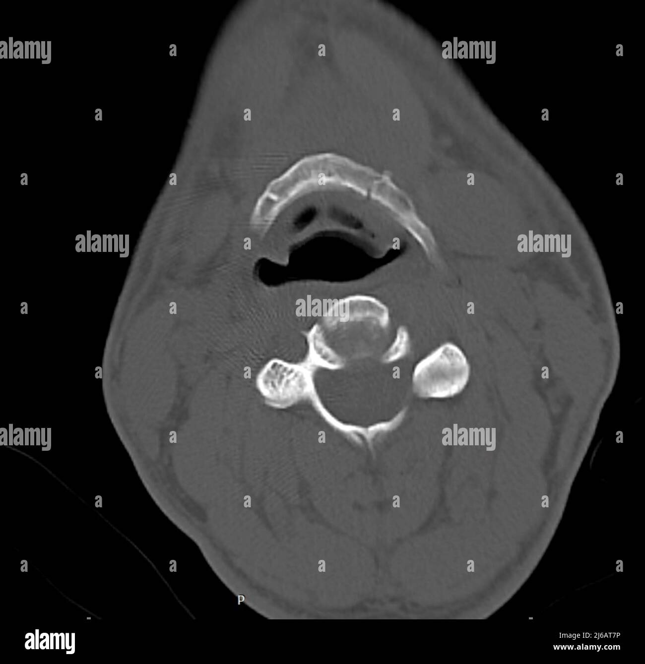 Fractured hyoid bone, CT scan Stock Photo - Alamy Fractured hyoid bone, CT scan Stock Photo - Alamy