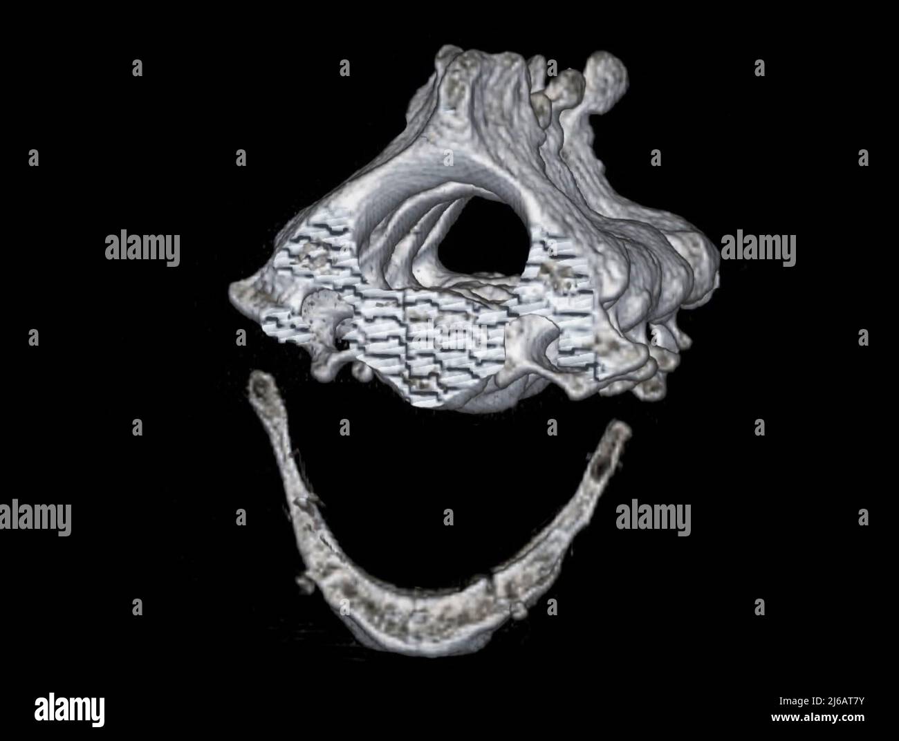 Fractured hyoid bone, 3D CT scan Stock Photo - Alamy Fractured hyoid bone, 3D CT scan Stock Photo - Alamy