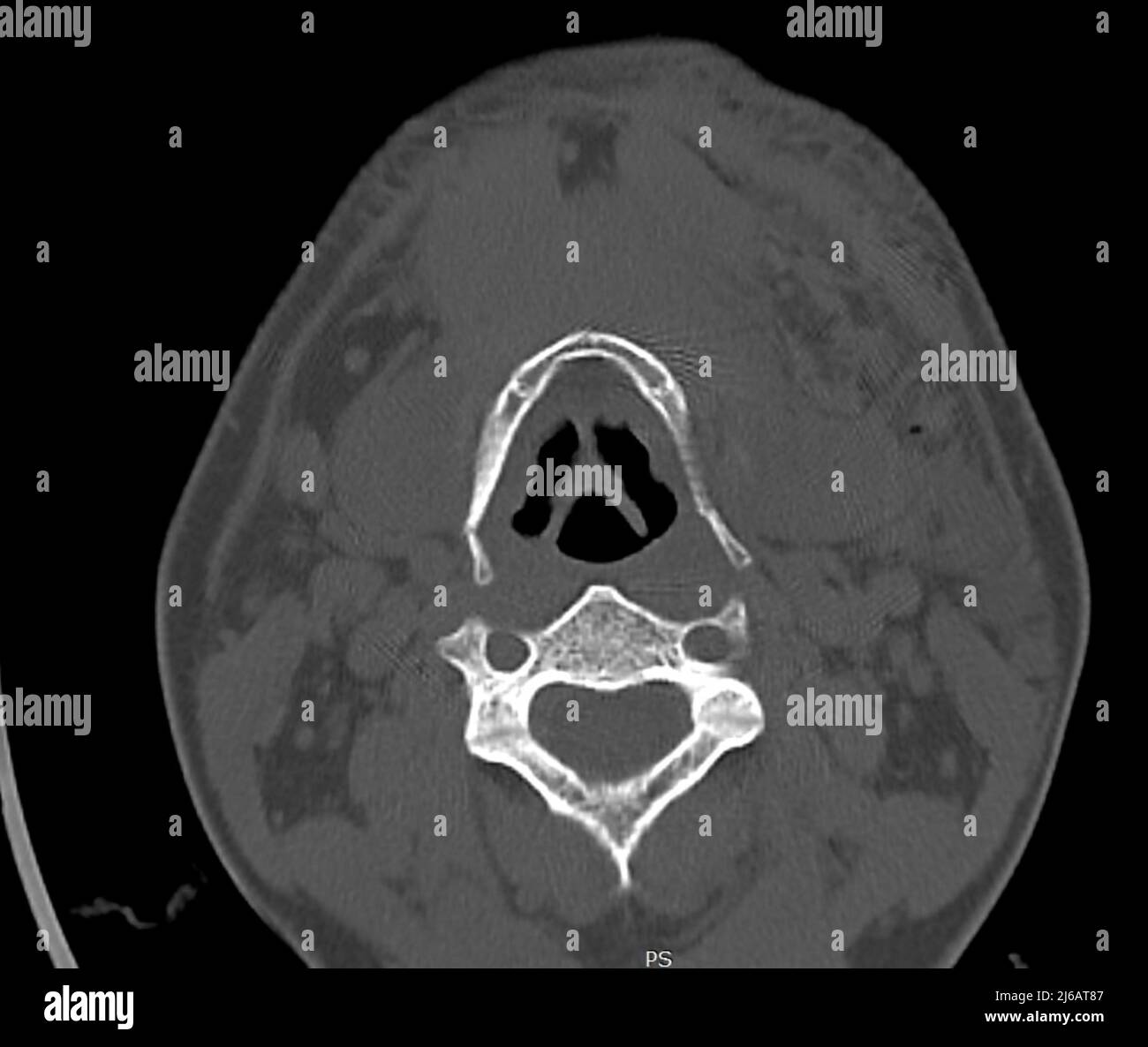 Fractured hyoid bone, CT scan Stock Photo - Alamy Fractured hyoid bone, CT scan Stock Photo - Alamy