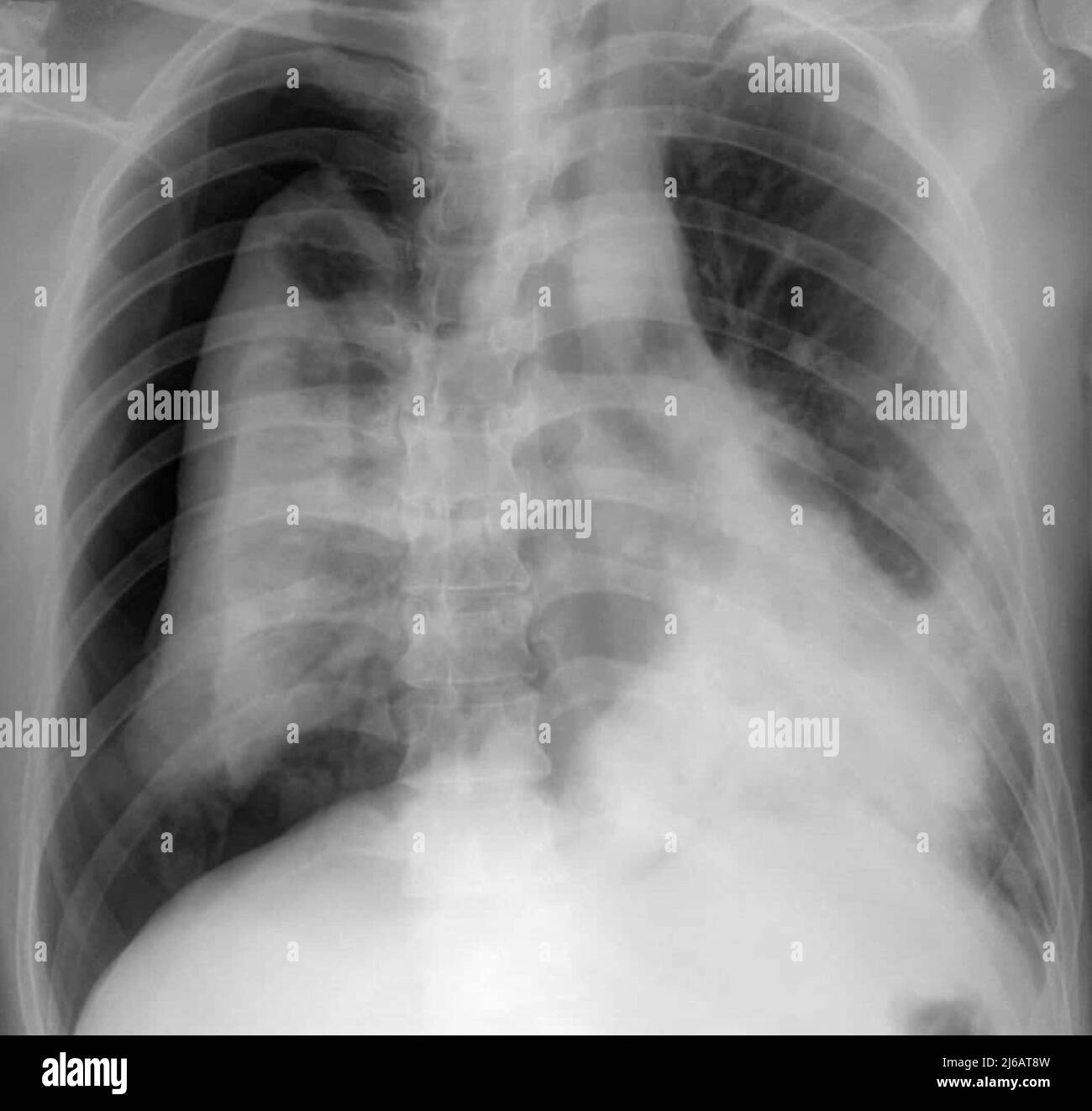Pneumothorax x ray hi-res stock photography and images - Alamy