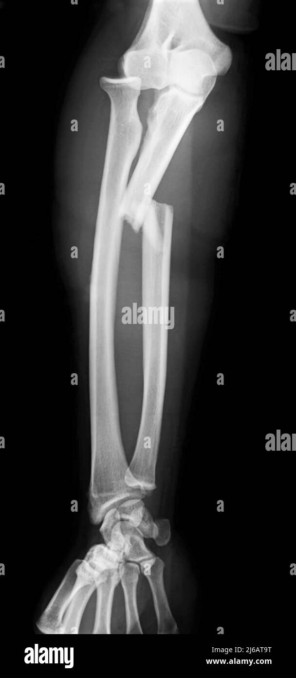 Monteggia Fracture