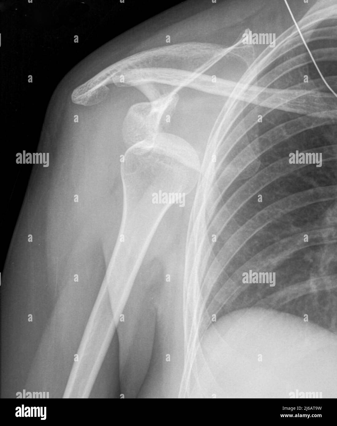 Shoulder dislocation hi-res stock photography and images - Alamy