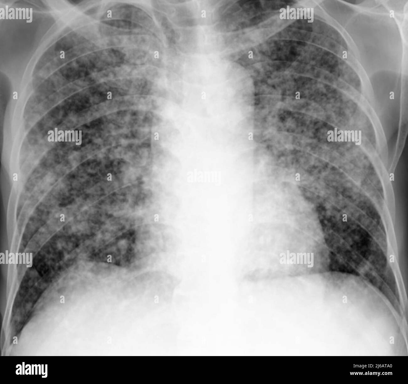 Abnormal Chest Xrays