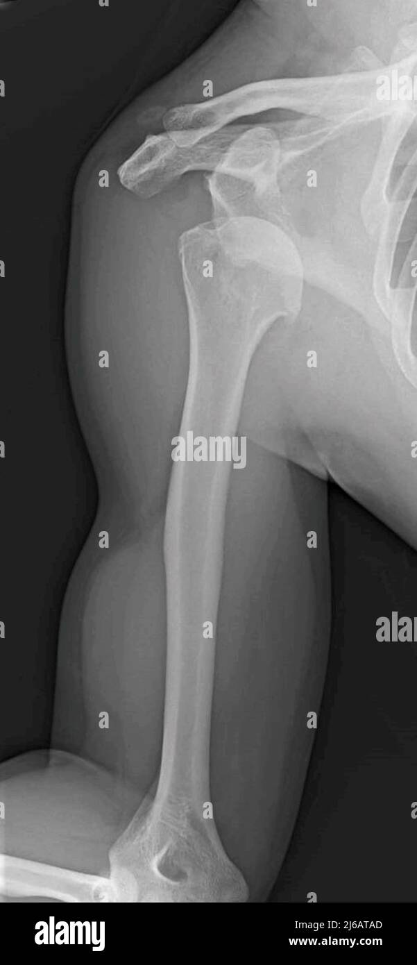 Dislocation shoulder hi-res stock photography and images - Alamy