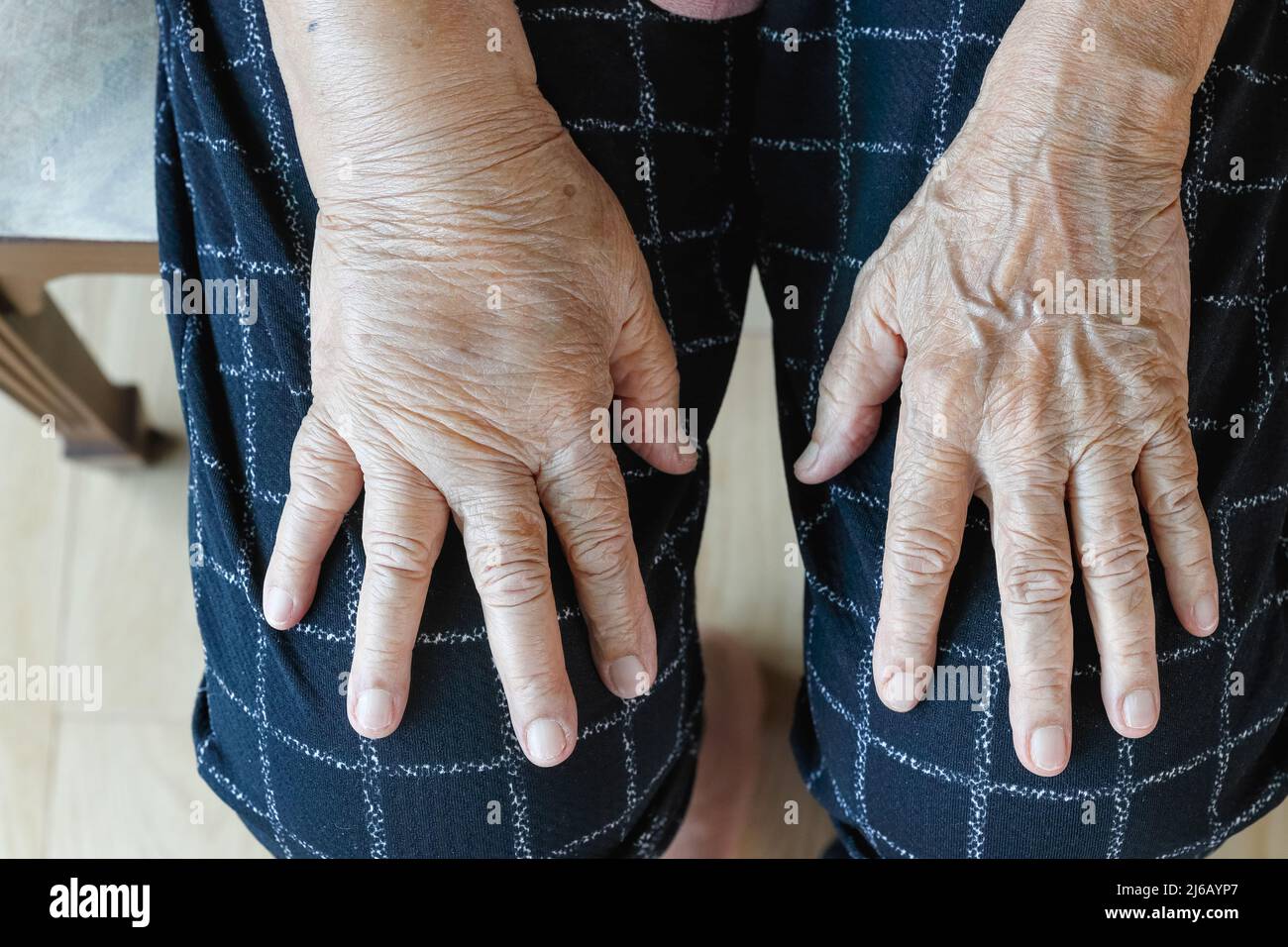 Elderly swollen hand or edema hand Stock Photo - Alamy