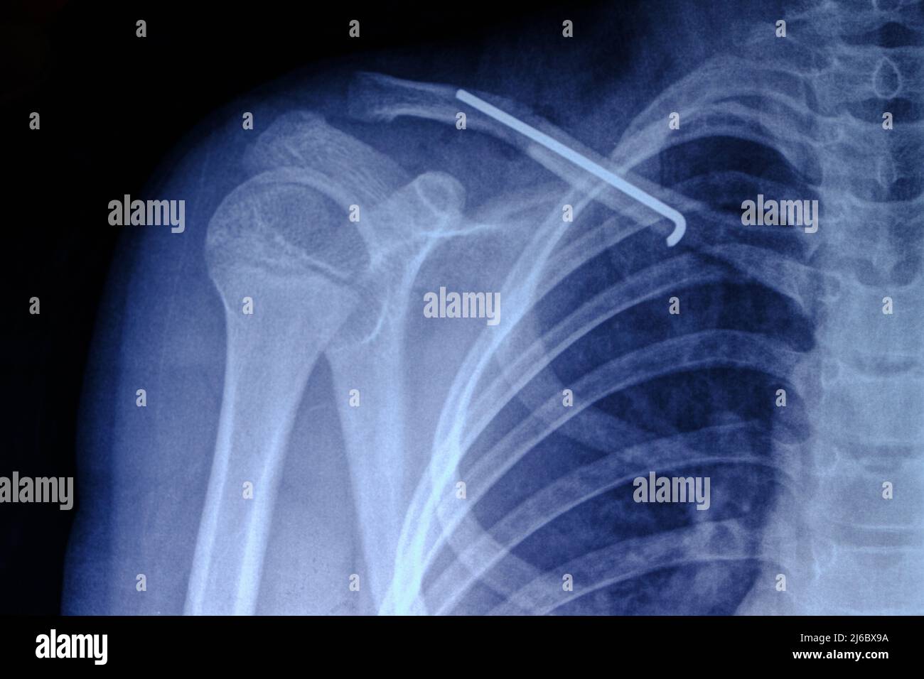 X ray image person with broken collarbone and spoke installed in it ...