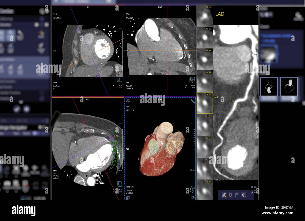 CTA Coronary artery 3D rendering image on the screen for diagnosis of ...