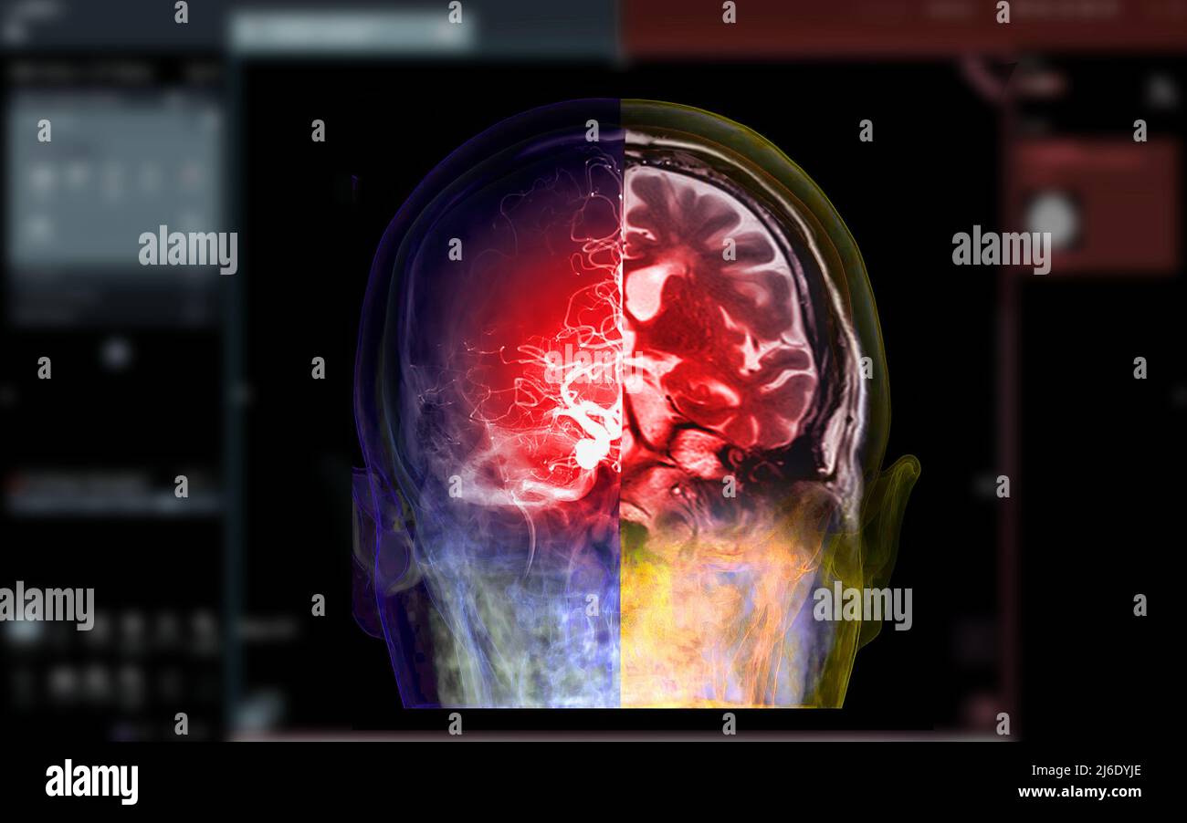 CTA brain and mri brain fusion image . medical technology concept Stock ...