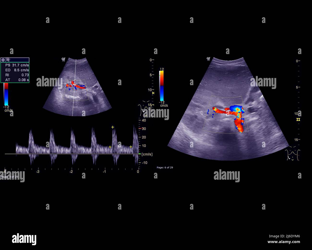 Common Hepatic Duct Ultrasound