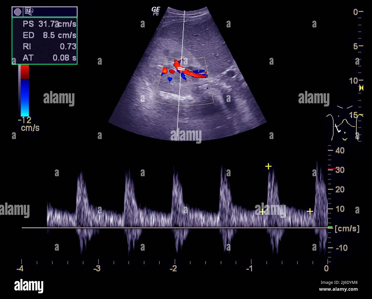Normal Common Bile Duct Ultrasound