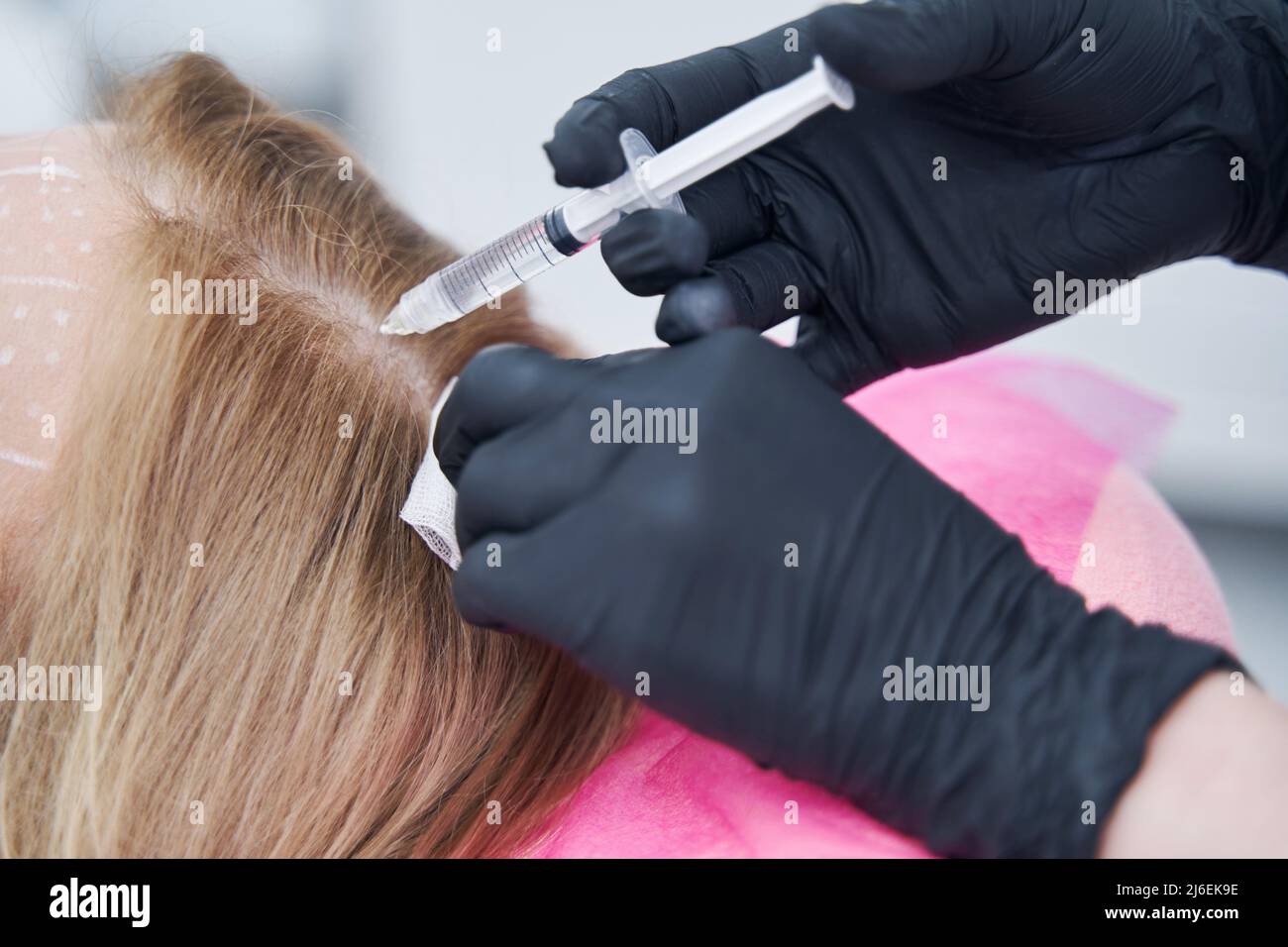 Woman getting injection into scalp during mesotherapy Stock Photo - Alamy
