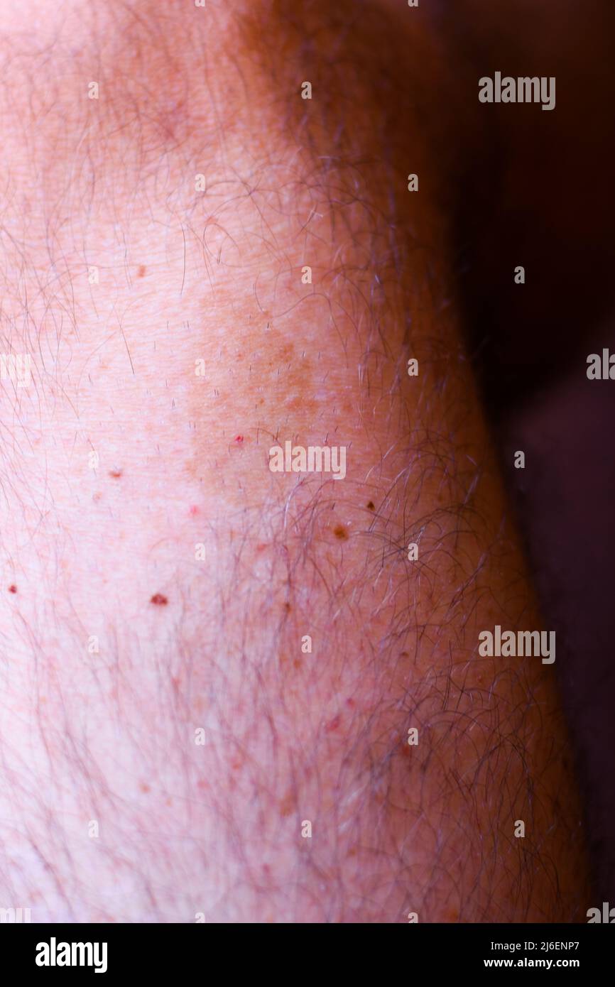 Birthmark on right leg hi-res stock photography and images - Alamy