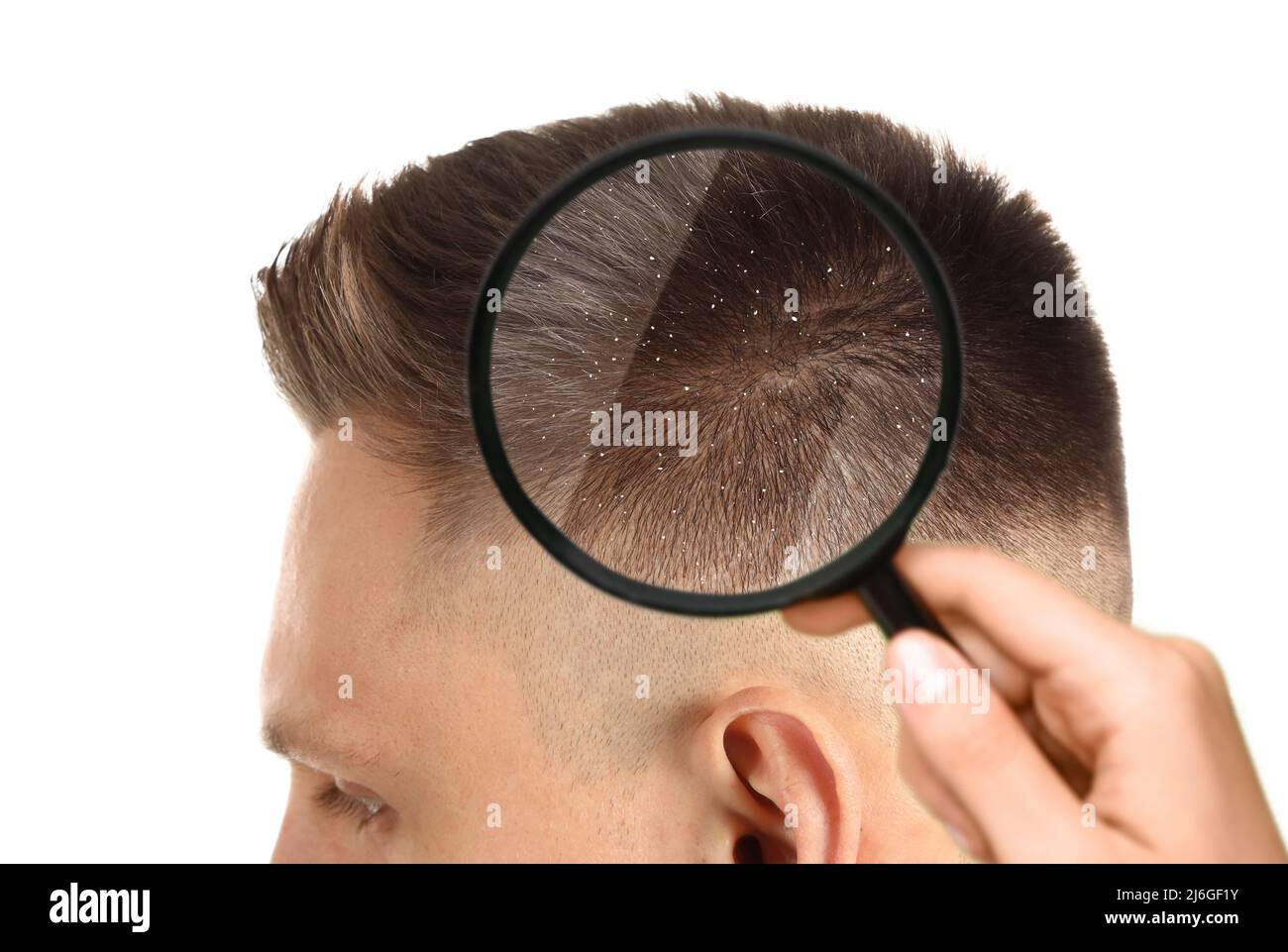Looking at young man's hair through magnifier. Problem of dandruff ...