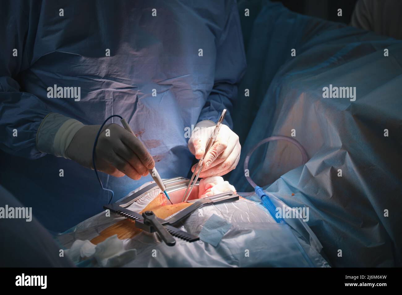 Closeup of doctors hands operating a patient conducting open cut ...