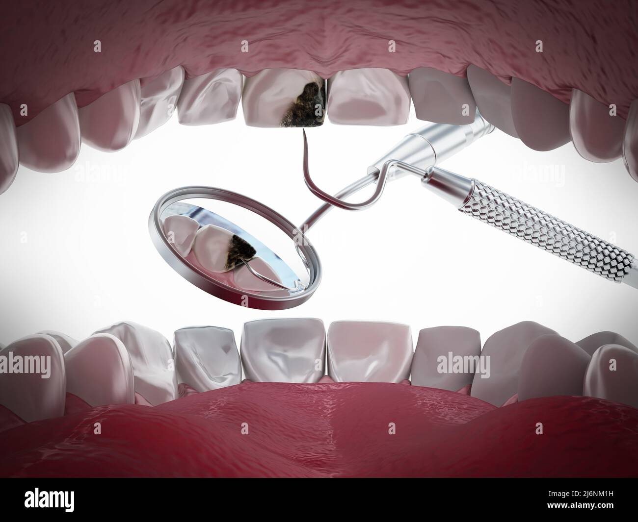 Decayed tooth diagnosis and treatment. 3D illustration Stock Photo - Alamy