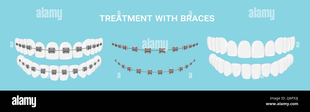 Teeth with or without braces. Arch braces without teeth. Orthodontic ...