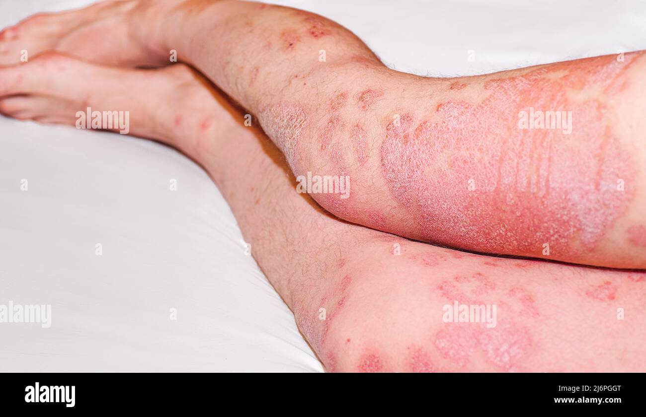 Acute Psoriasis Severe Reddening Of The Skinan Autoimmuneincurable Dermatological Skin