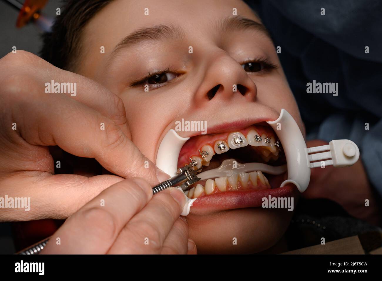 White retractor on the lips and the installation of metal braces on the ...