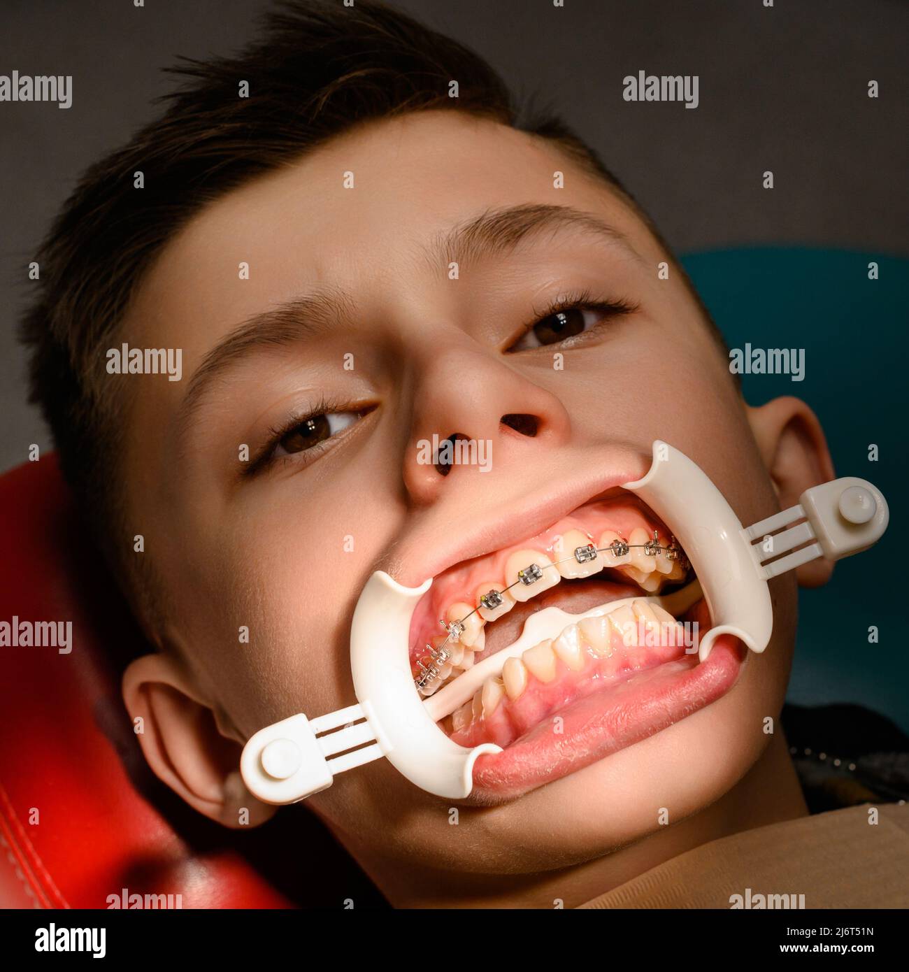 Visit to the orthodontist, installation of braces on the upper teeth ...
