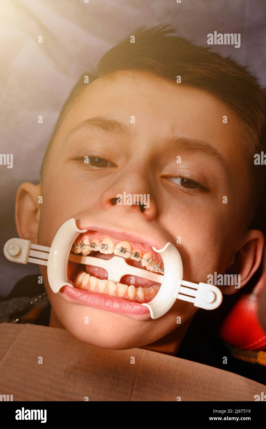 Visit to the orthodontist, installation of braces on the upper teeth ...