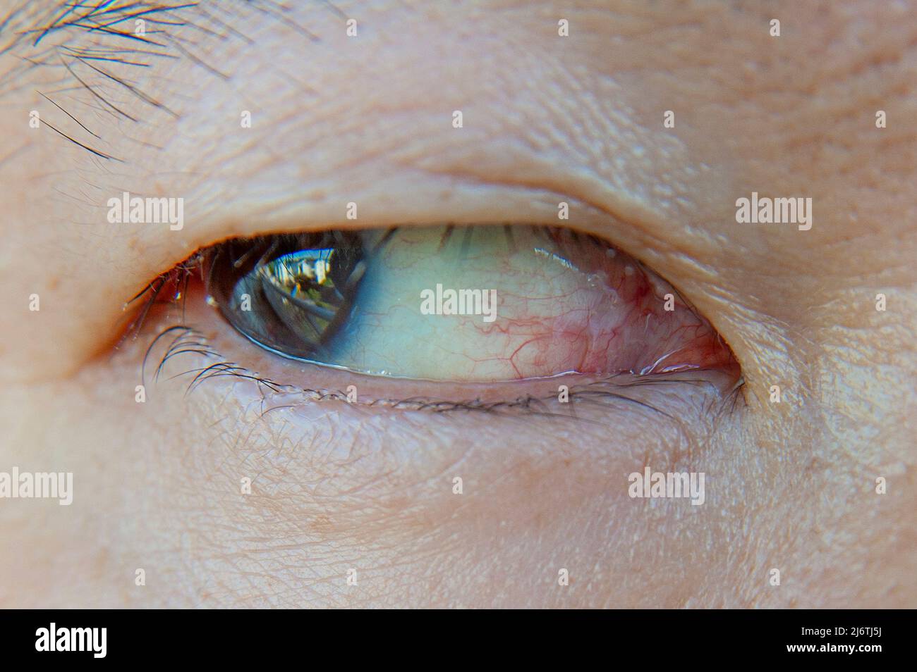 Close-up of right eye of Asian man with eye irritation problem Stock ...