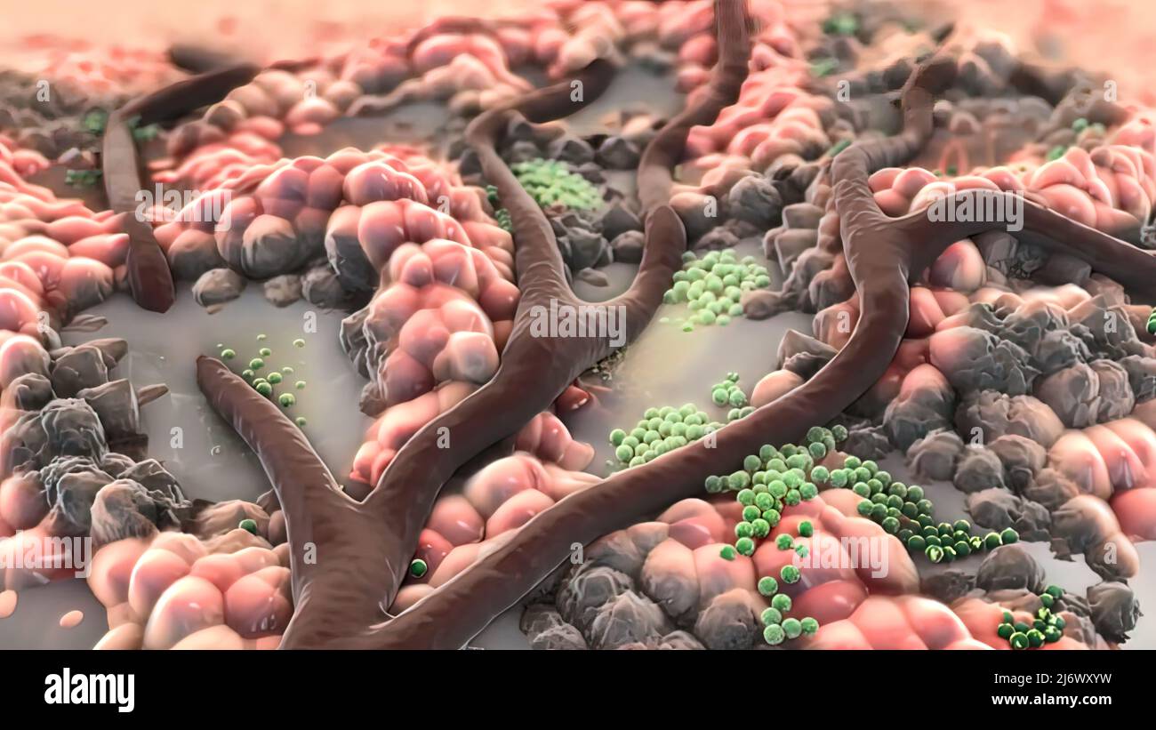 Pus Cells High Resolution Stock Photography and Images - Alamy