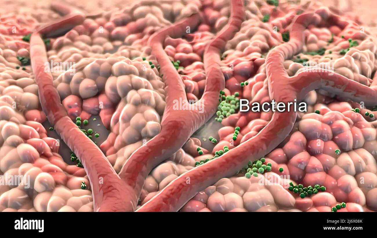 Pus Cells High Resolution Stock Photography and Images - Alamy