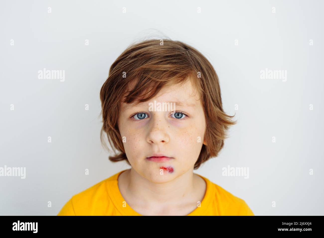 Portrait of school boy kid child with sore bruised wound on his face ...