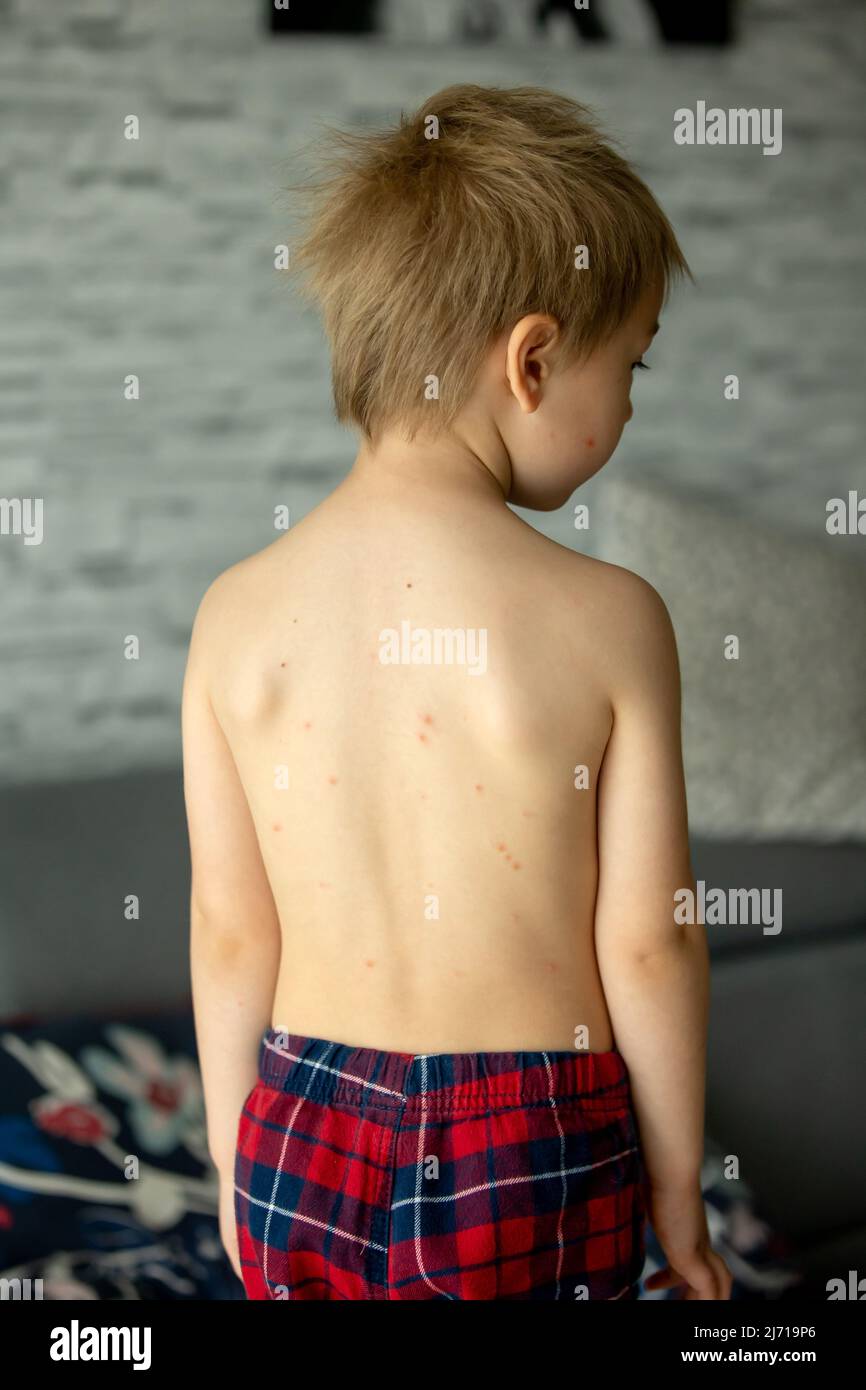 Toddler child, boy with chicken pox, mild rash, first stage of the ...
