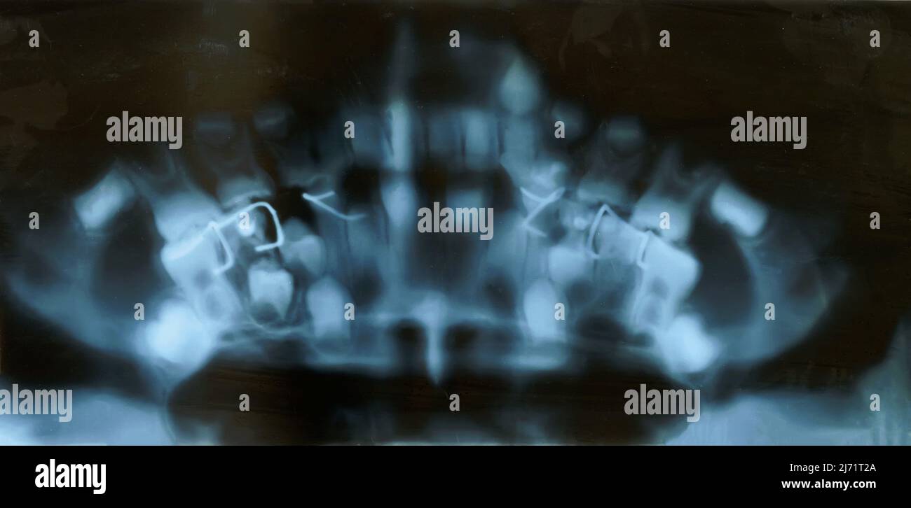 Dental x-ray with metal clips, dental research. Dental radiogram Stock ...