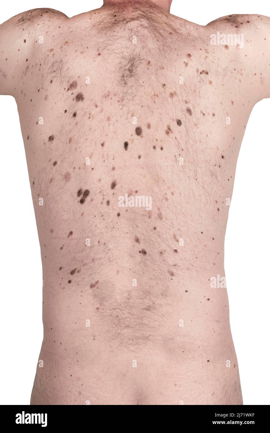 Maennlicher Ruecken mit Leberflecken, Muttermalen und Alterswarzen ...