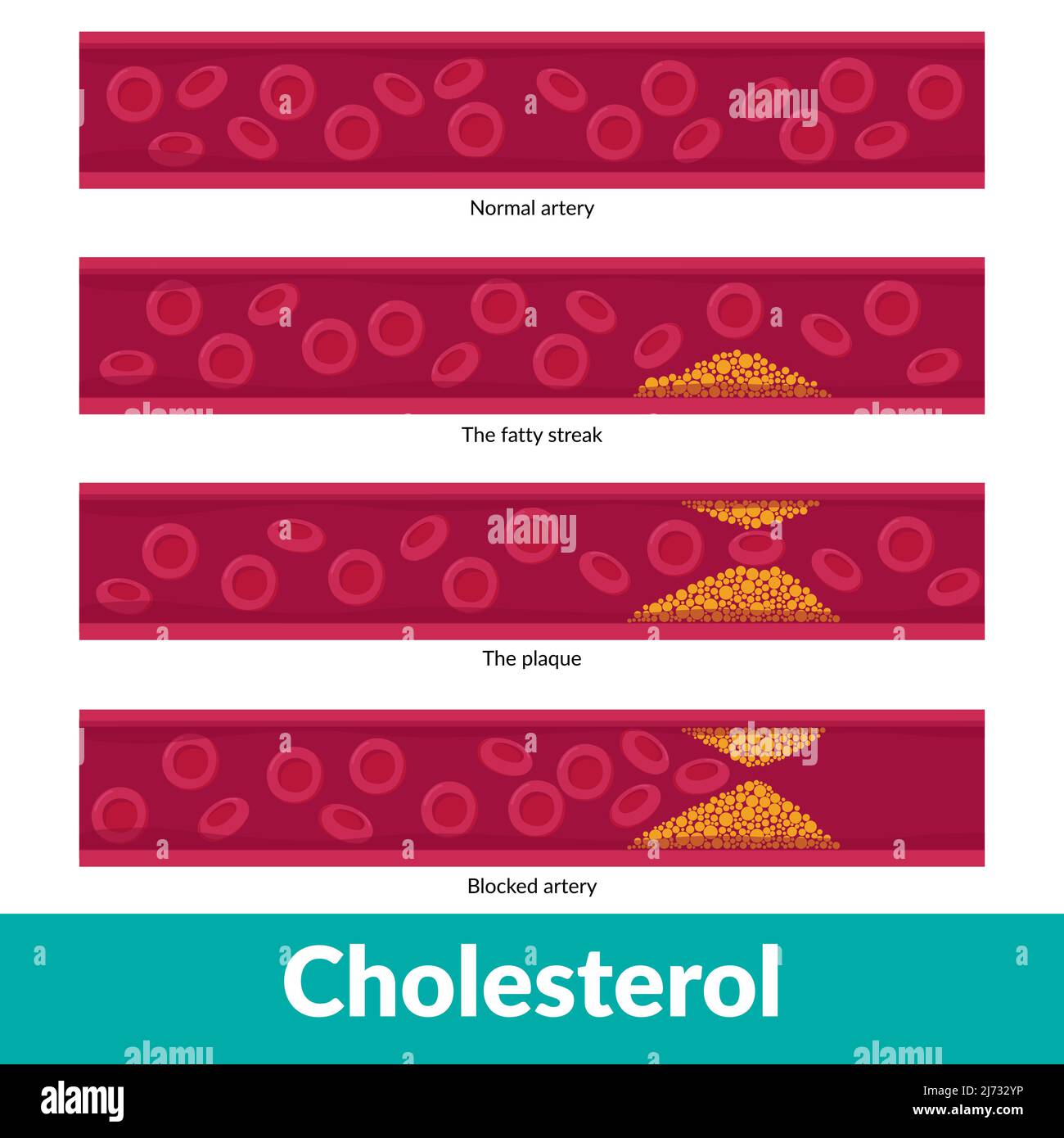 How Does A Fatty Streak Happen In Arteries