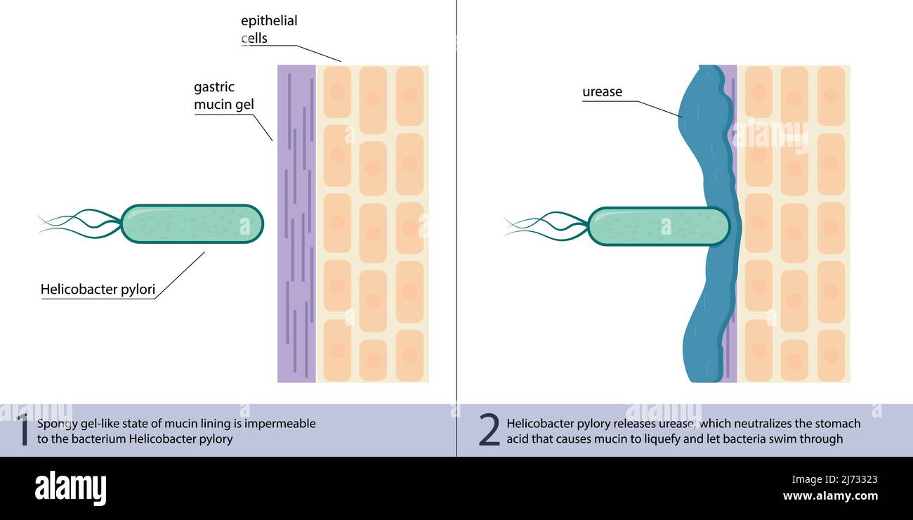 Invasion of Helicobacter pylori into the tissues of the stomach, by ...