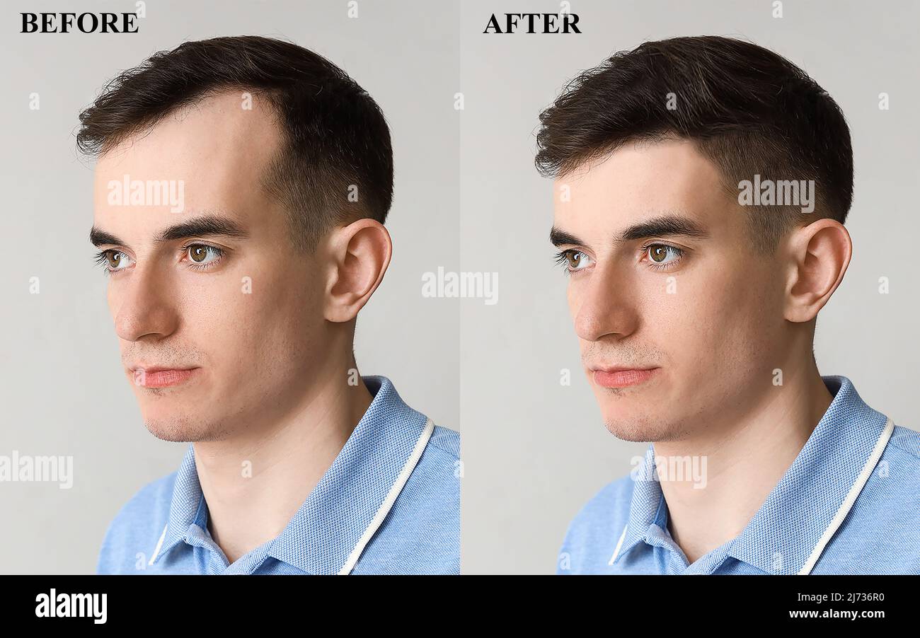 Young man before and after hair loss treatment on light background ...