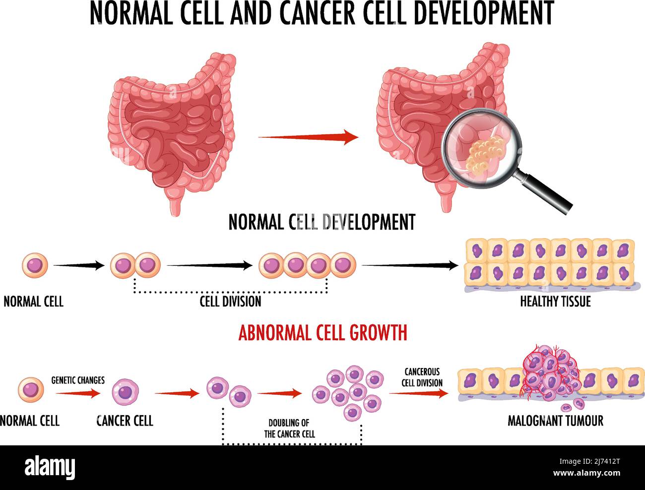 Diagram showing normal and cancer cells illustration Stock Vector Image ...