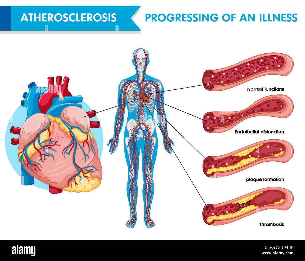 Atherosclerosis Progression Of An Illness Illustration Stock Vector Image And Art Alamy