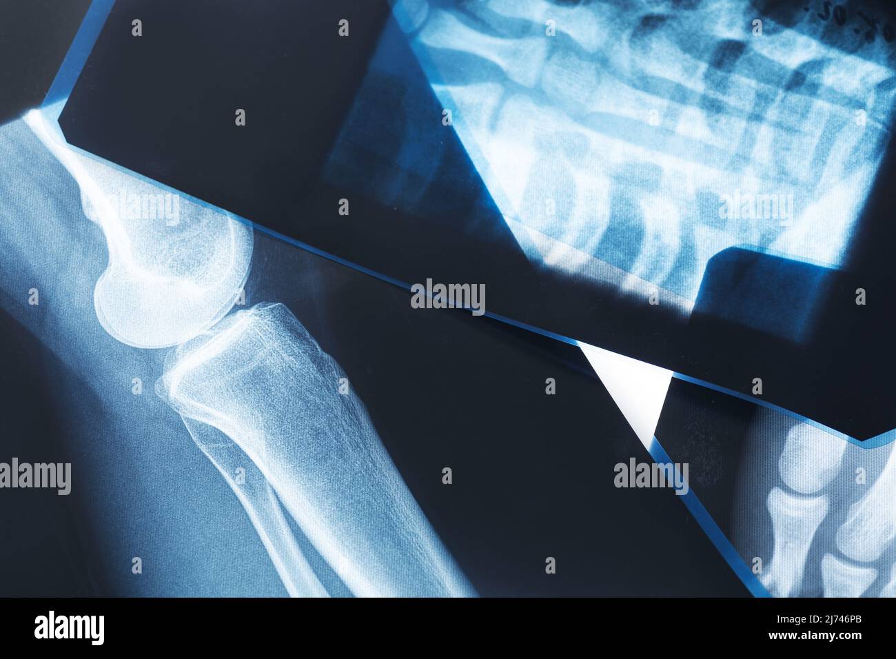 Forensic x ray hi-res stock photography and images - Alamy