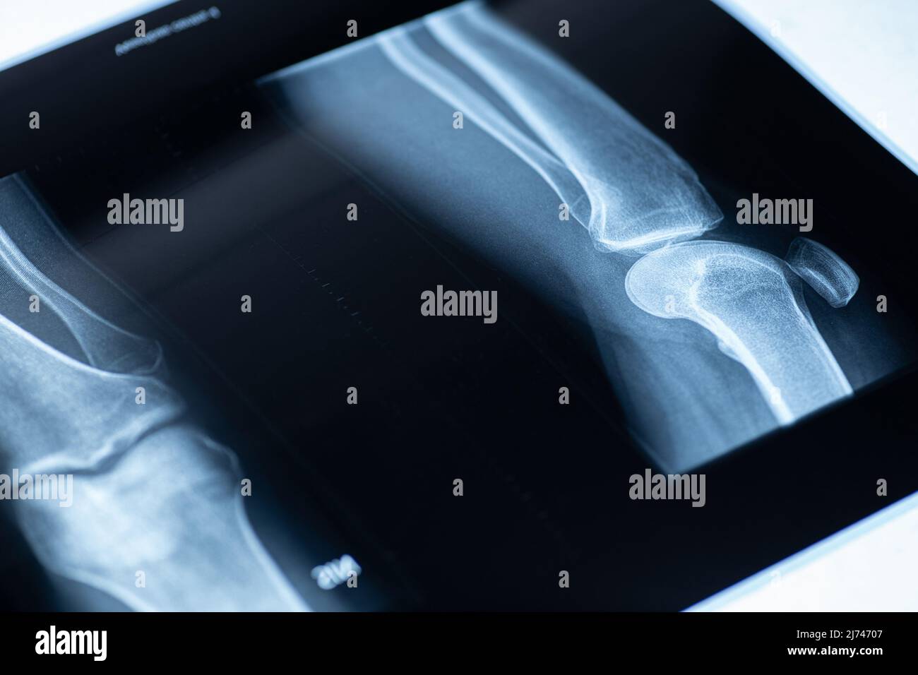 X-ray of human knee. Problems with bone or joint Stock Photo - Alamy